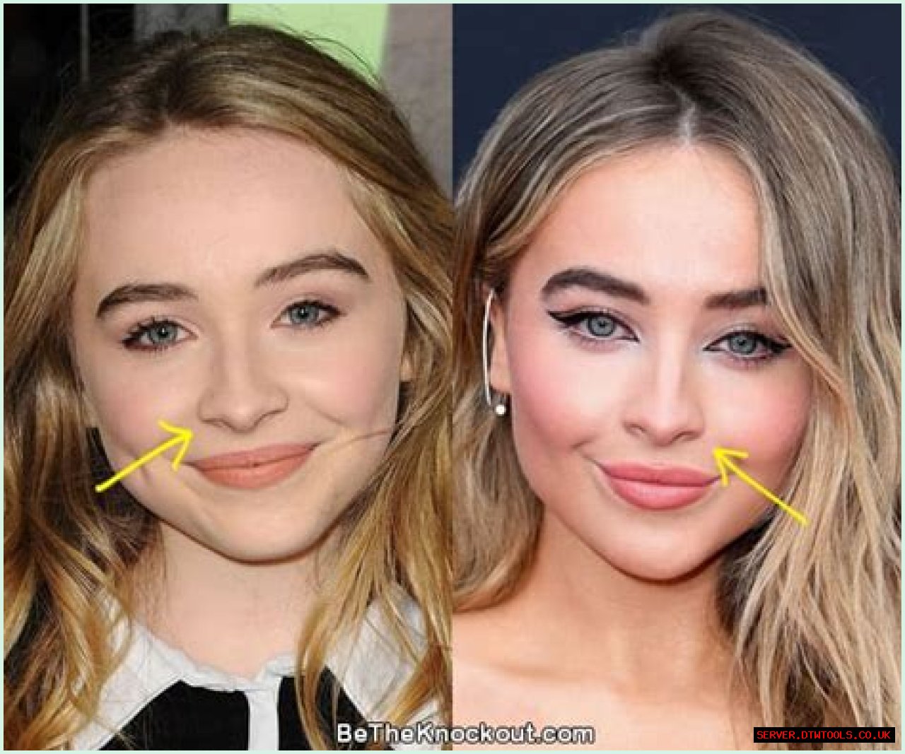 The Transformation Of Sabrina Carpenter: Before And After Fillers Revealed
